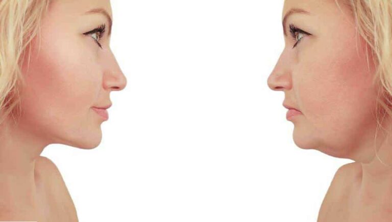 ¿Qué operación estética debo hacerme para adelgazar el mentón?